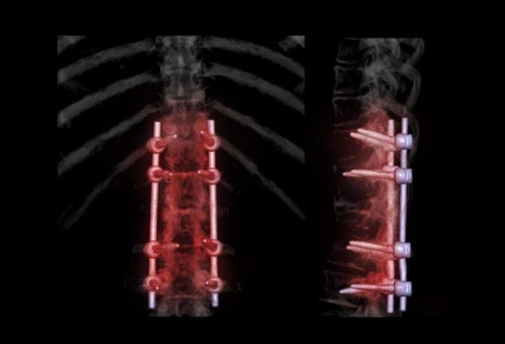 What Is The Best Treatment For Spinal Stenosis
