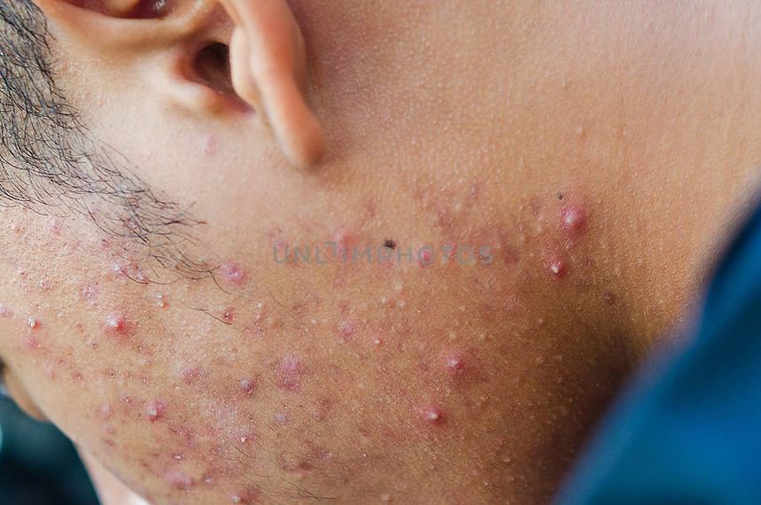 How To Get Rid Of Whiteheads: Here Are The 10 Best Ways