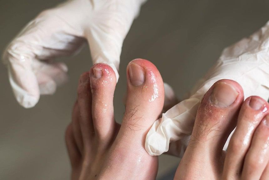 What Not To Do When You Have Shingles